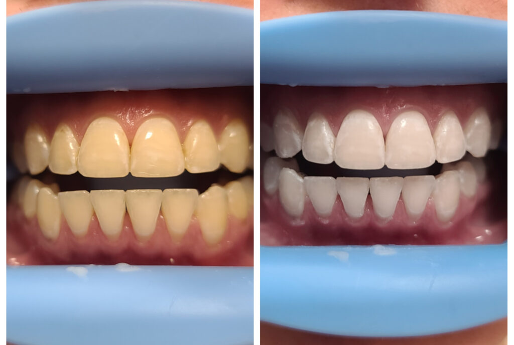 Expert Teeth Whitening | Six Point Dental in Etobicoke